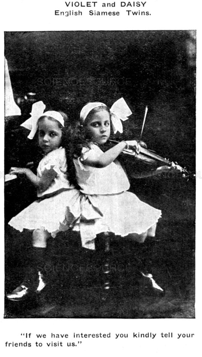 Violet and Daisy Hilton, San Antonio’s conjoined twins. Their uplifting ...